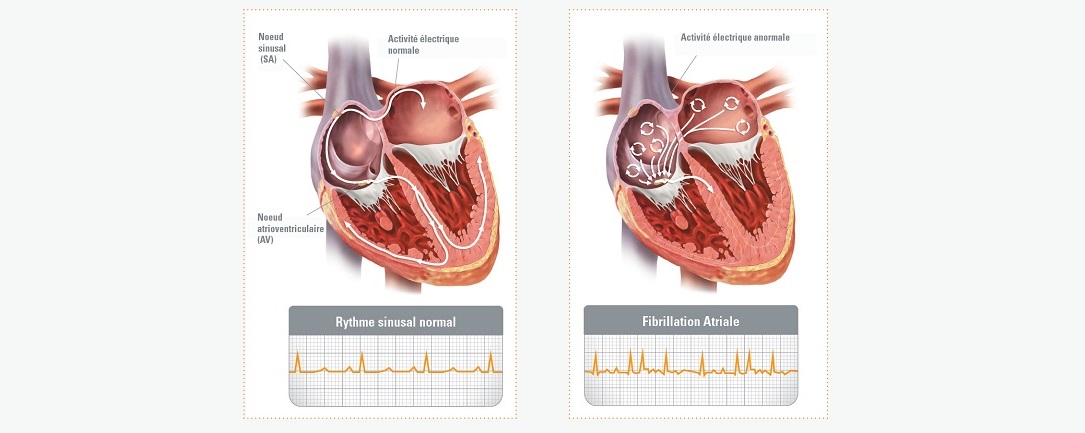 Qu'est-ce qui caractérise la Fibrillation Atriale? | Tout savoir sur la FA